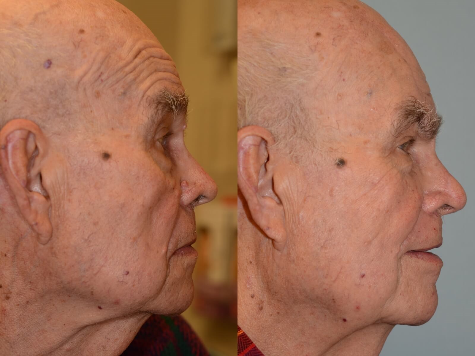 Forehead Flap Reconstruction Of Nasal Tip Following Mohs