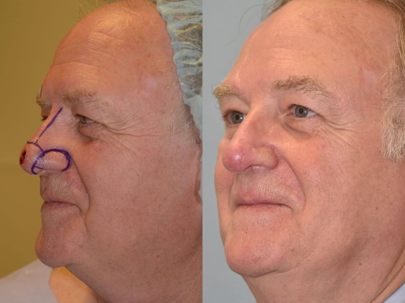 Nasal Skin Cancer Reconstruction